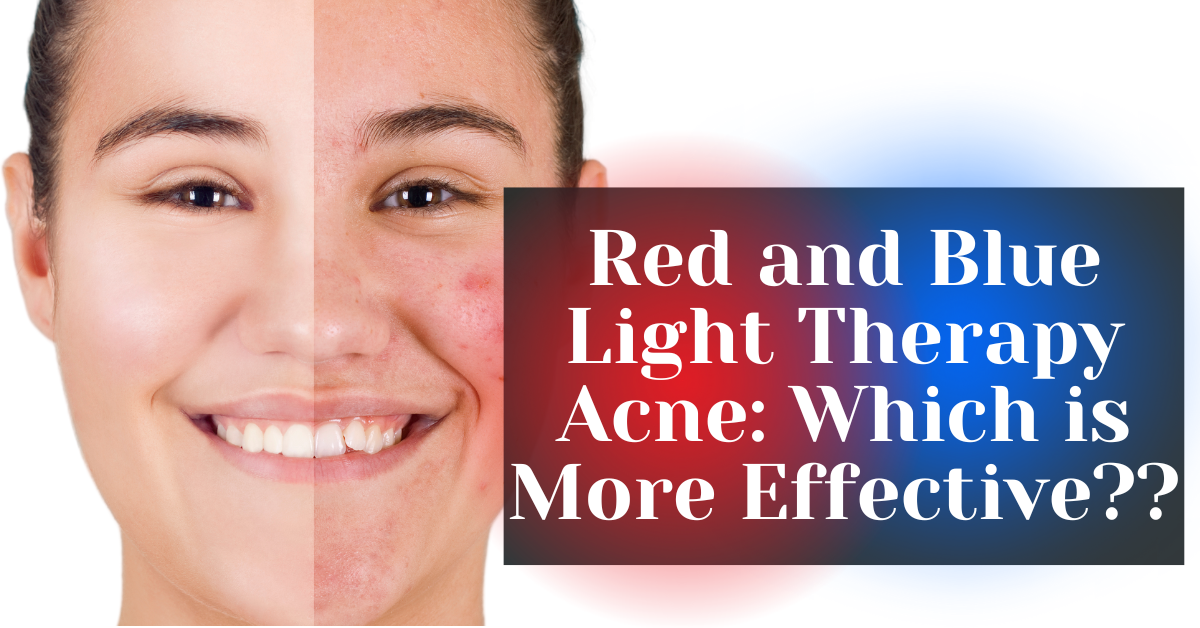 Red and Blue Light Therapy Acne: Which is More Effective??